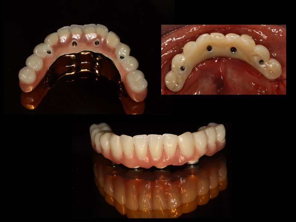 Bridge sur pilotis - Cabinet Dentaire Dr Delphine Reys