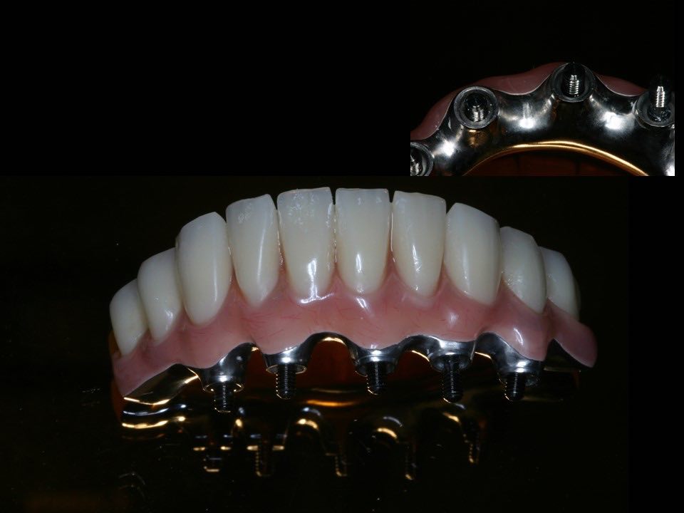 Bridge sur pilotis - Cabinet Dentaire Dr Delphine Reys