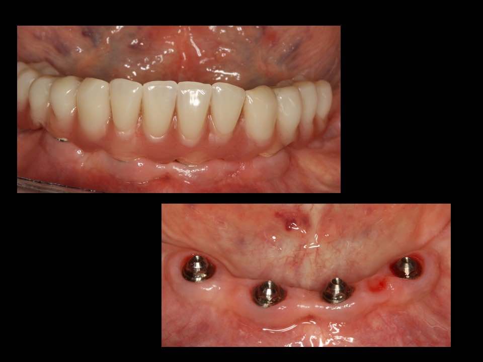 Bridge sur pilotis - Cabinet Dentaire Dr Delphine Reys